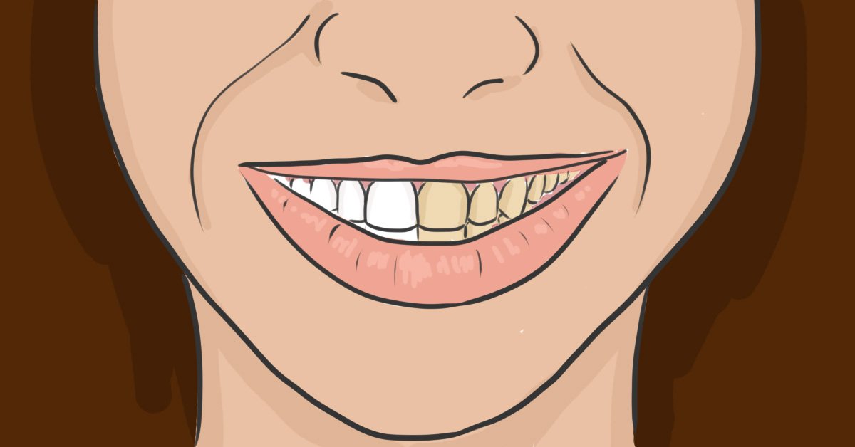 Как проводить отбеливание зубов дома